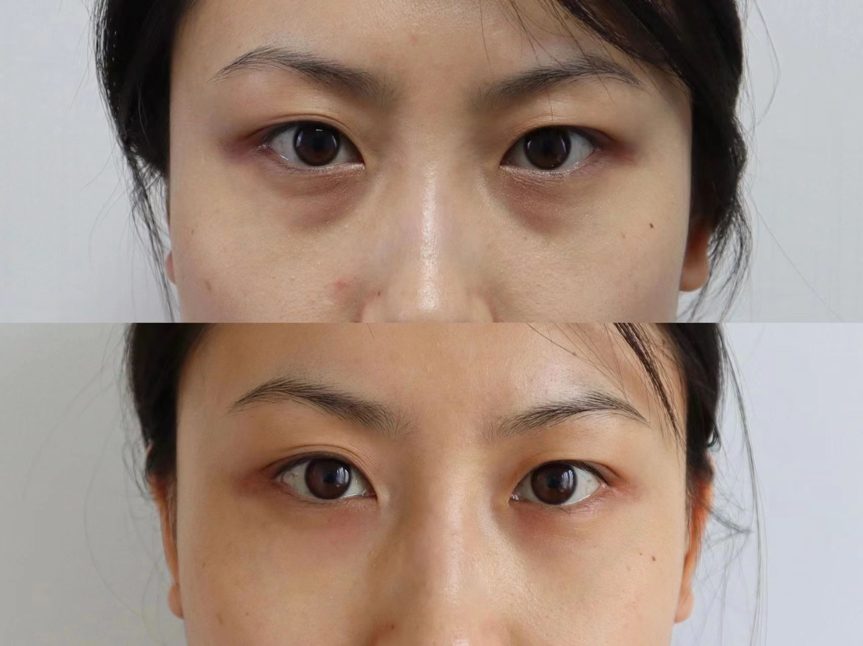 Premature aging, how to improve the 38 lines on the face [law lines ...