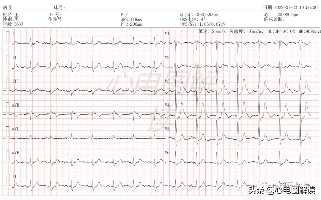 Dynamic changes of electrocardiogram in exertional angina pectoris - iNEWS