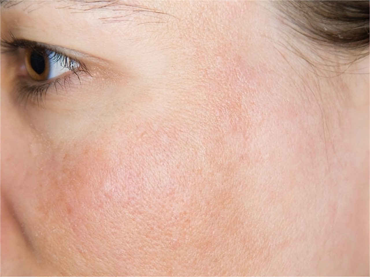 Suitable crowd for photorejuvenation - iNEWS