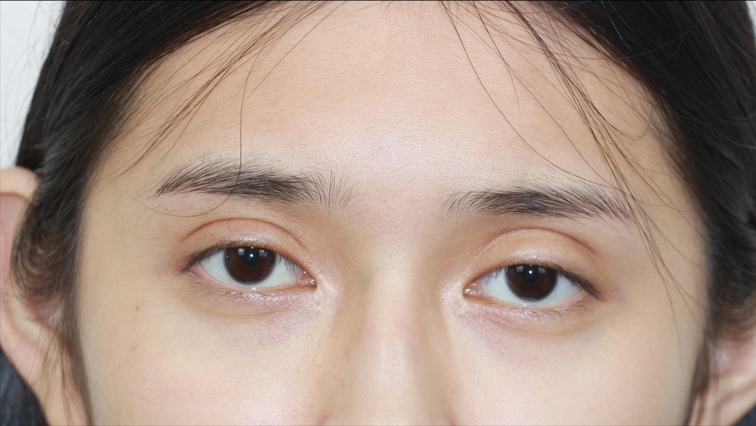 Why is it difficult to change from wide to narrow when double eyelid ...