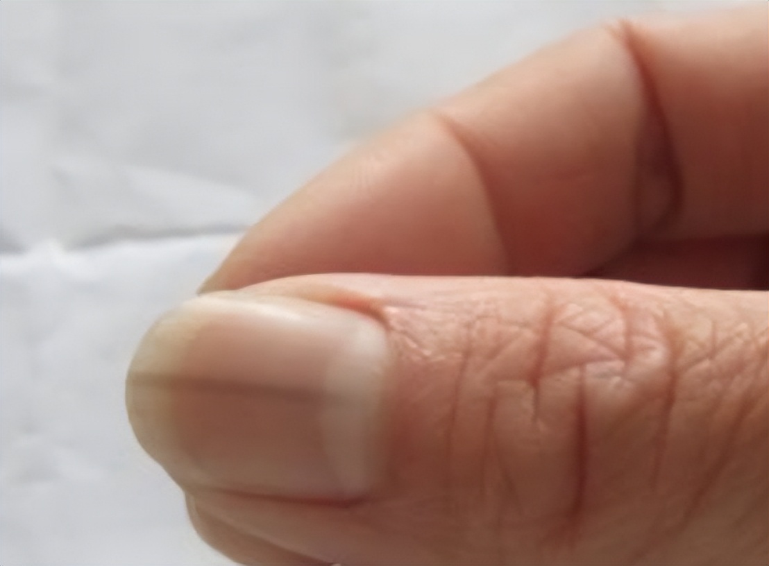 If the nails grow into three shapes, it may be a signal of cancer or ...