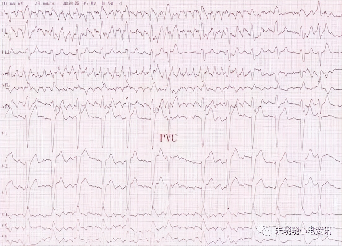 Teach you to identify interference and artifact in ECG - iNEWS
