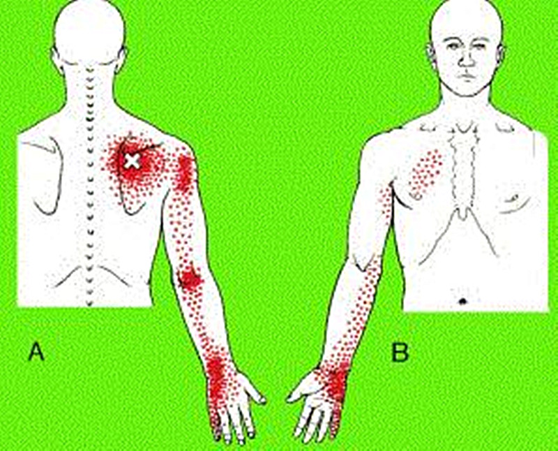 Chest pain, back pain, left arm pain, have not been able to find the ...