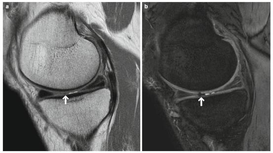Magnetic resonance meniscus calcification, ossification and vacuum ...