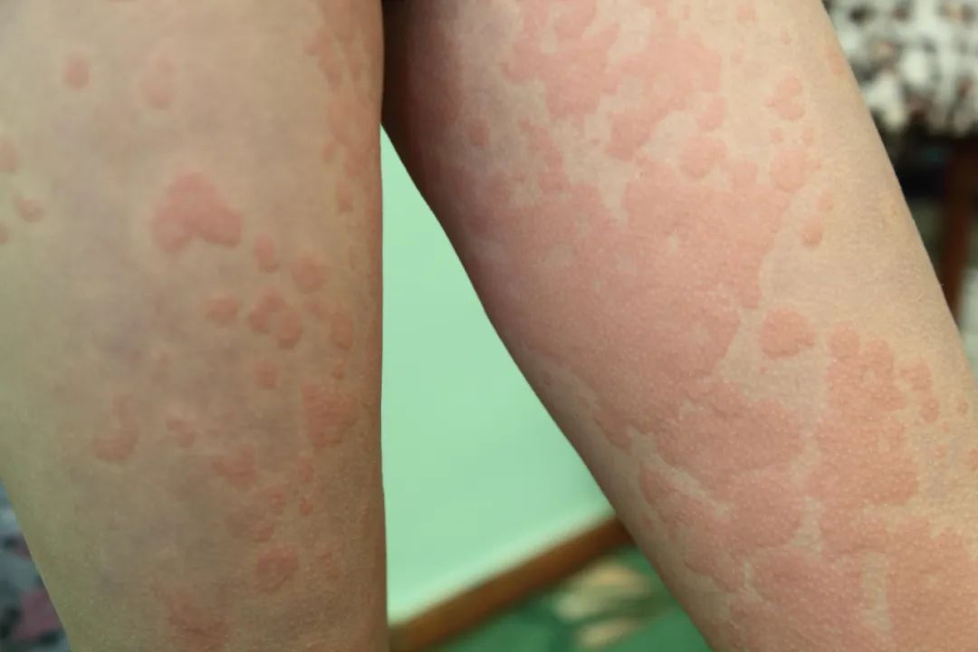 Severe itching of hives?The doctor said bluntly: 3 traditional Chinese ...