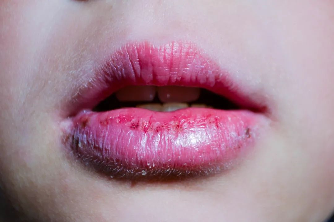 Are your lips chapped and prone to peeling because of the dry weather ...