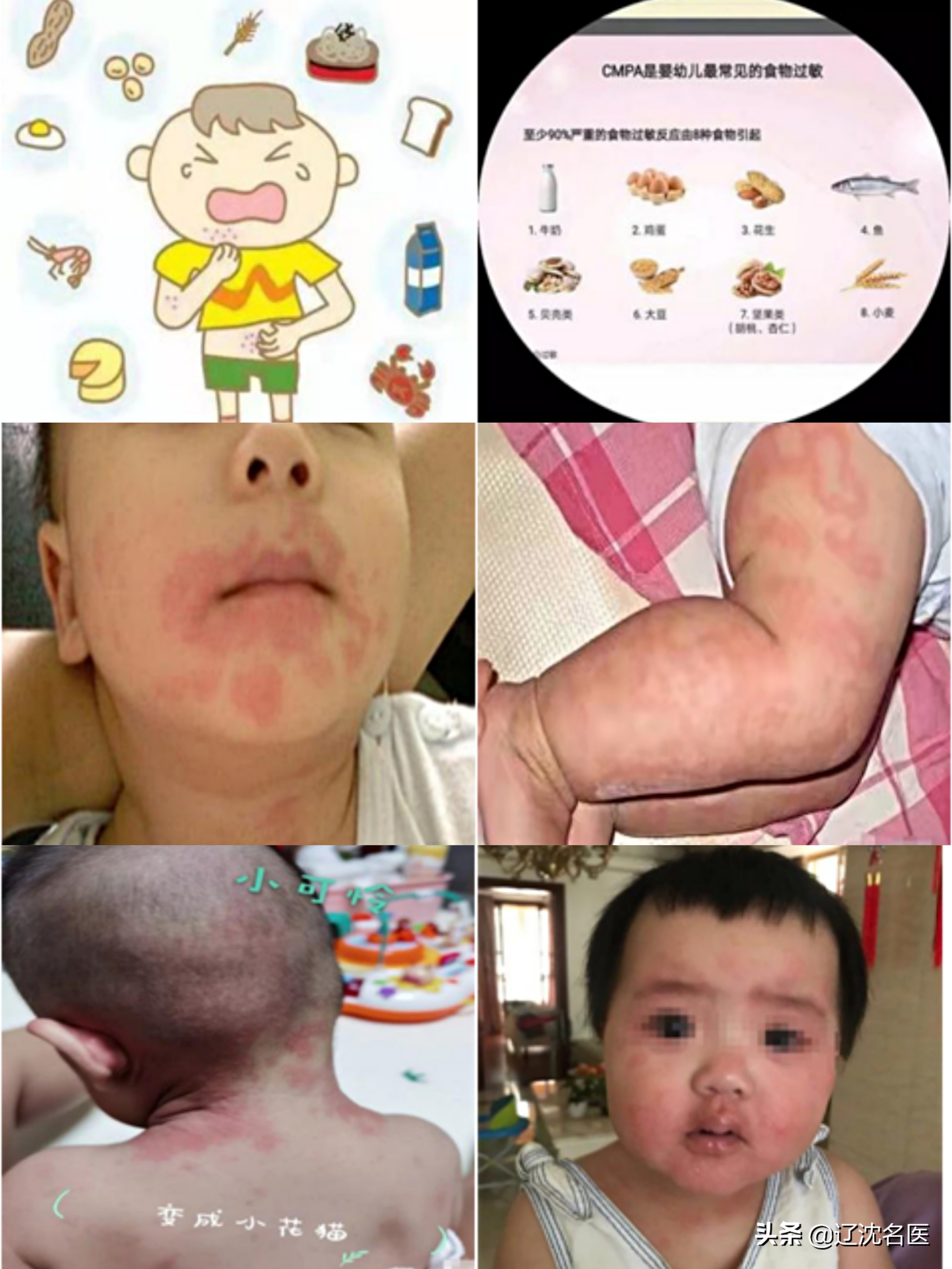 Watch out for food allergies in children - iNEWS