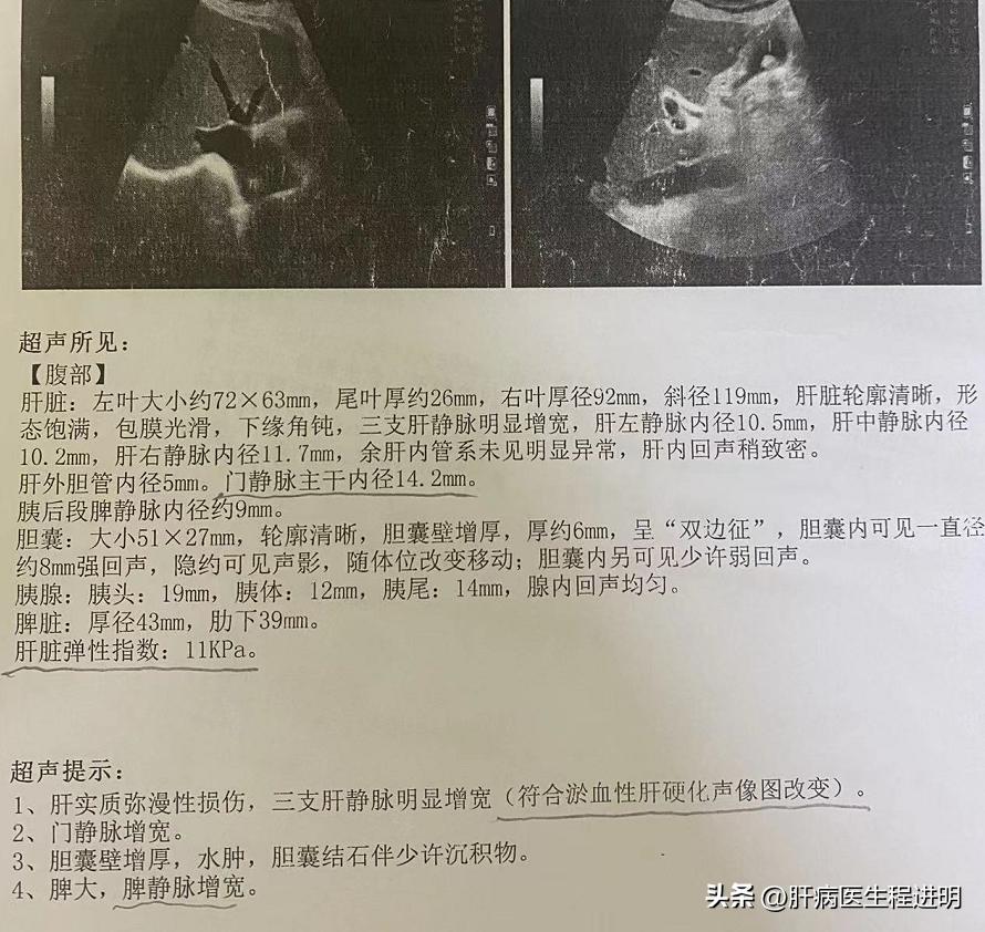 Cardiogenic liver cirrhosis, cured after three months of traditional ...