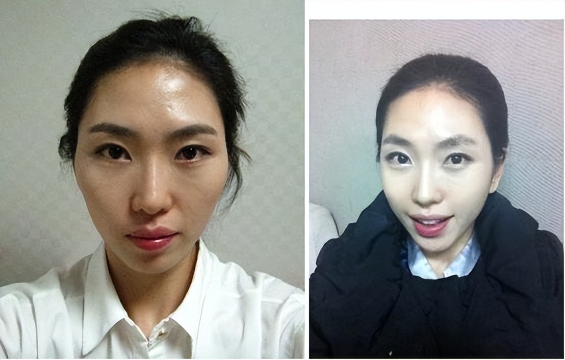 The way of cheekbones plastic surgery, there are some plastic surgery ...