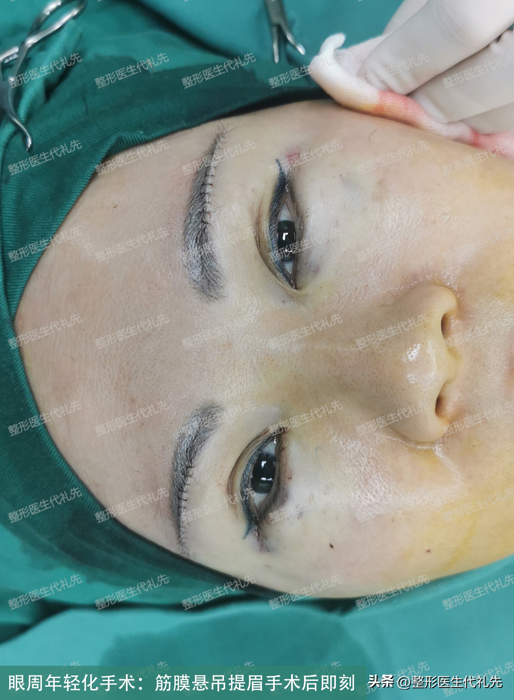 After the brow lift surgery, a friend said, "My eyes look at least 10 ...