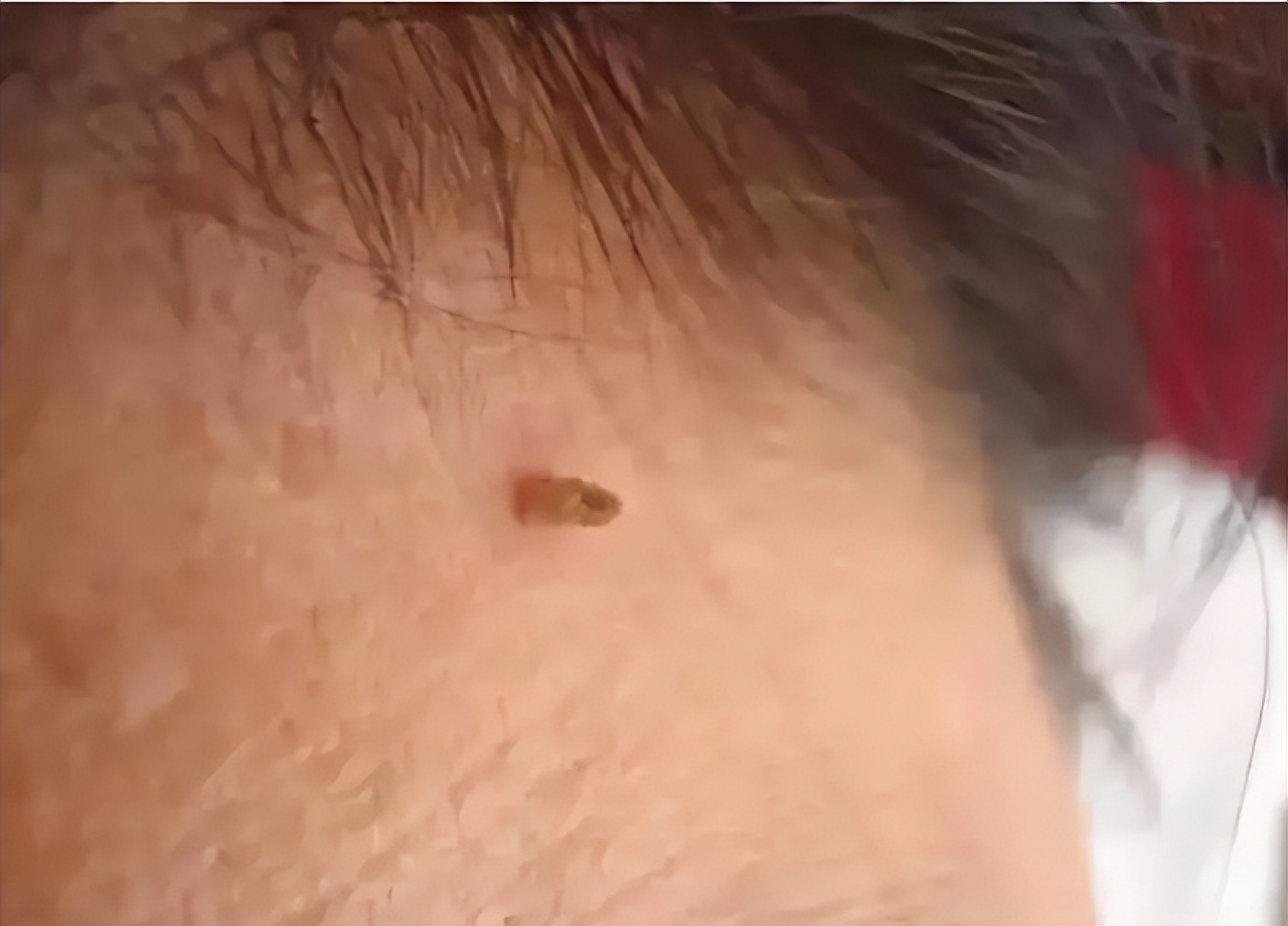 What are the "small meat particles" on the neck and armpit?Can you just ...