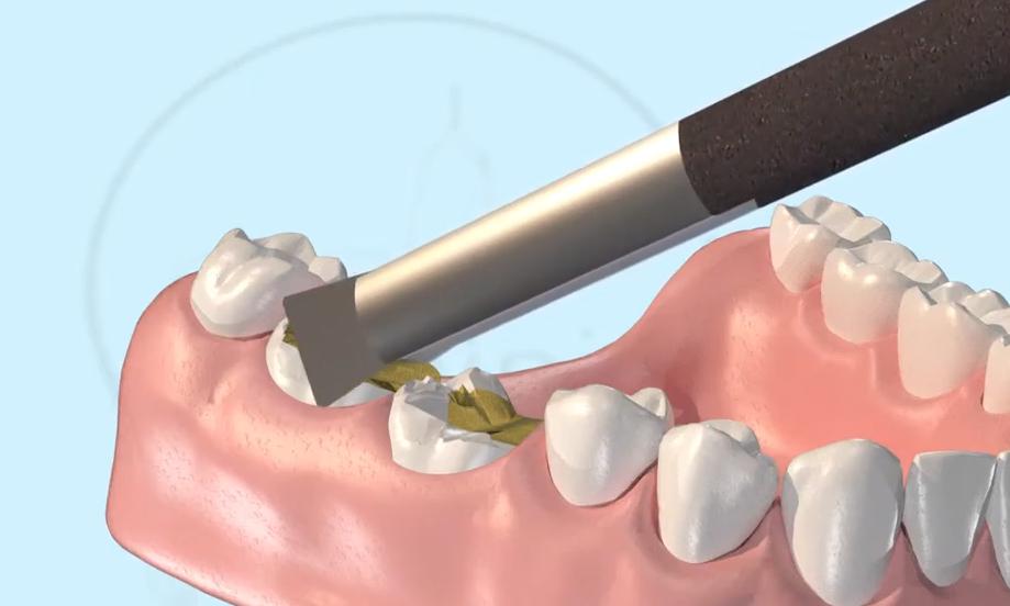 Dry socket, especially painful, how to prevent it after tooth ...