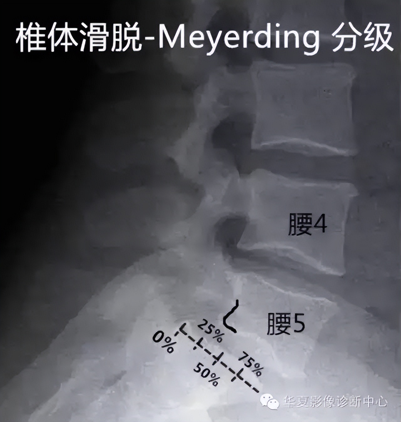 Illustration of sacral lumbarization, lumbar sacralization, lumbar ...