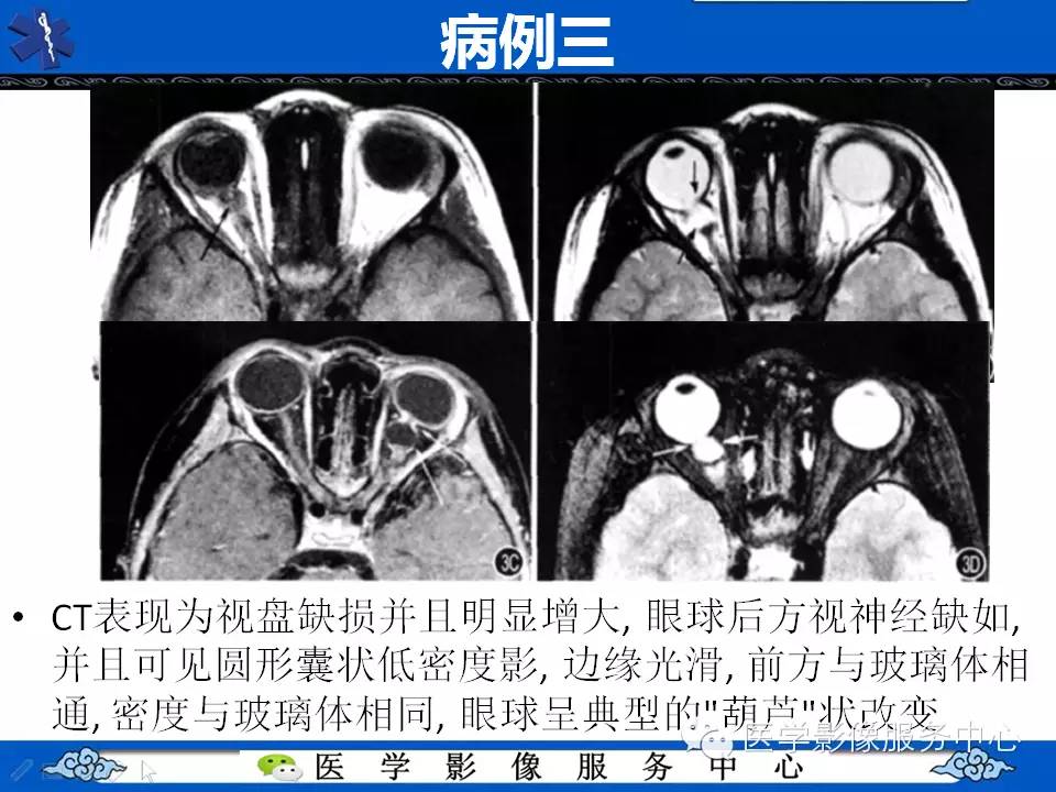 Good article sharing——CT and MRI Diagnosis of Morning Glory Syndrome ...