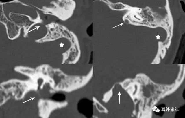 Common Abnormal Temporal Bone CT Summary - iNEWS