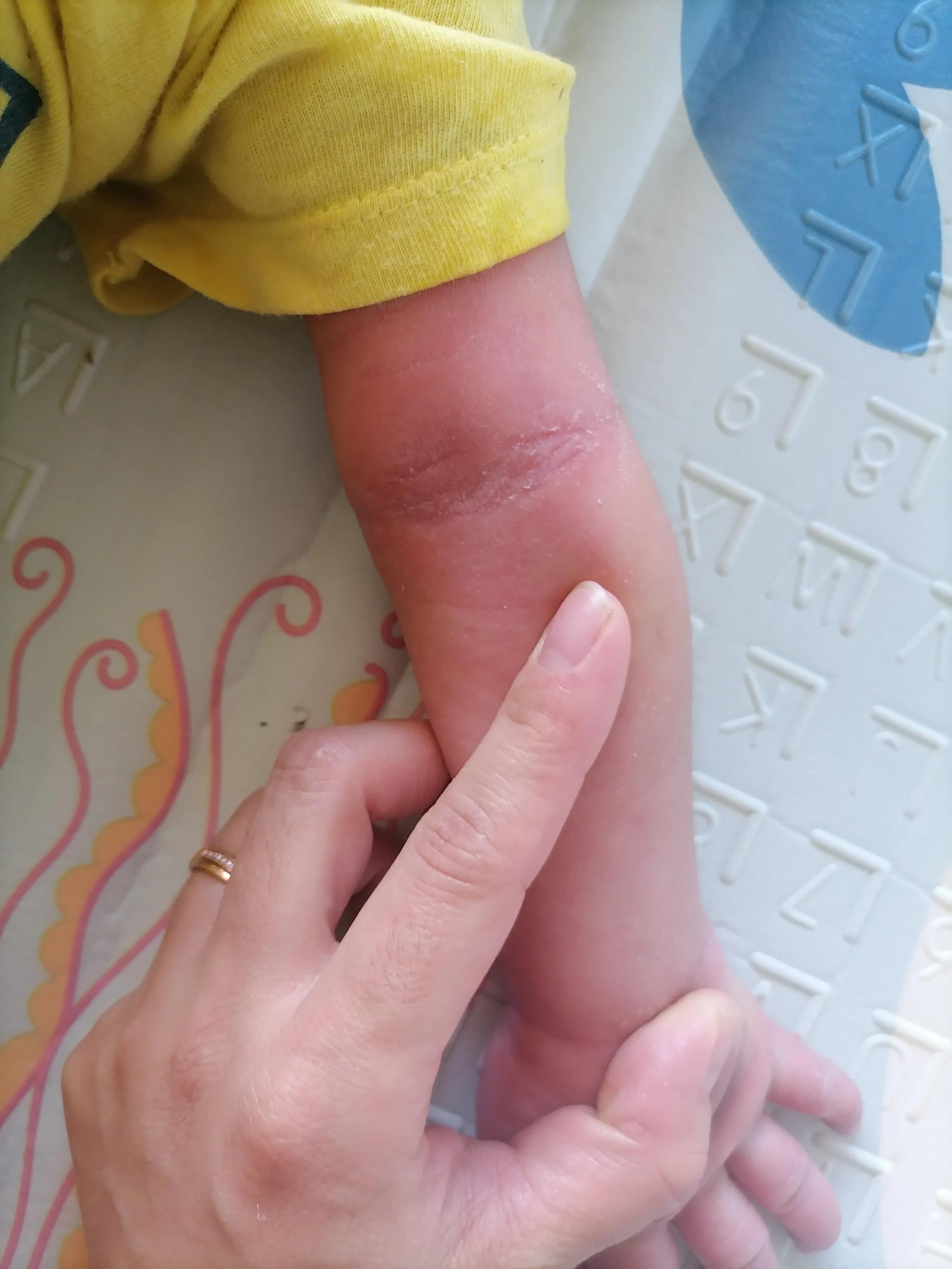 baby with atopic dermatitis - iNEWS