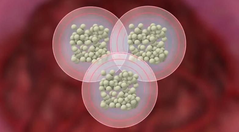 How strong is yttrium 90 microspheres, a new technology for liver ...