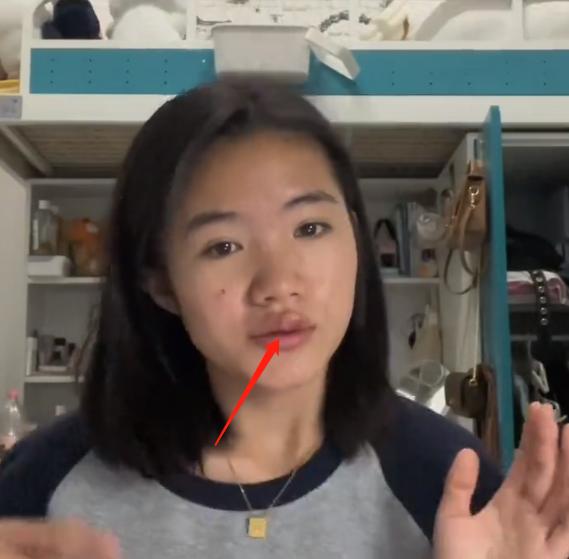 Is Li Leyou suspected of being ill? His eyes are red and his lips are red and swollen like ...