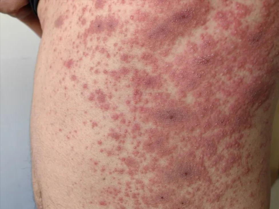 Generalized erythema multiforme, how to cause it? - iNEWS
