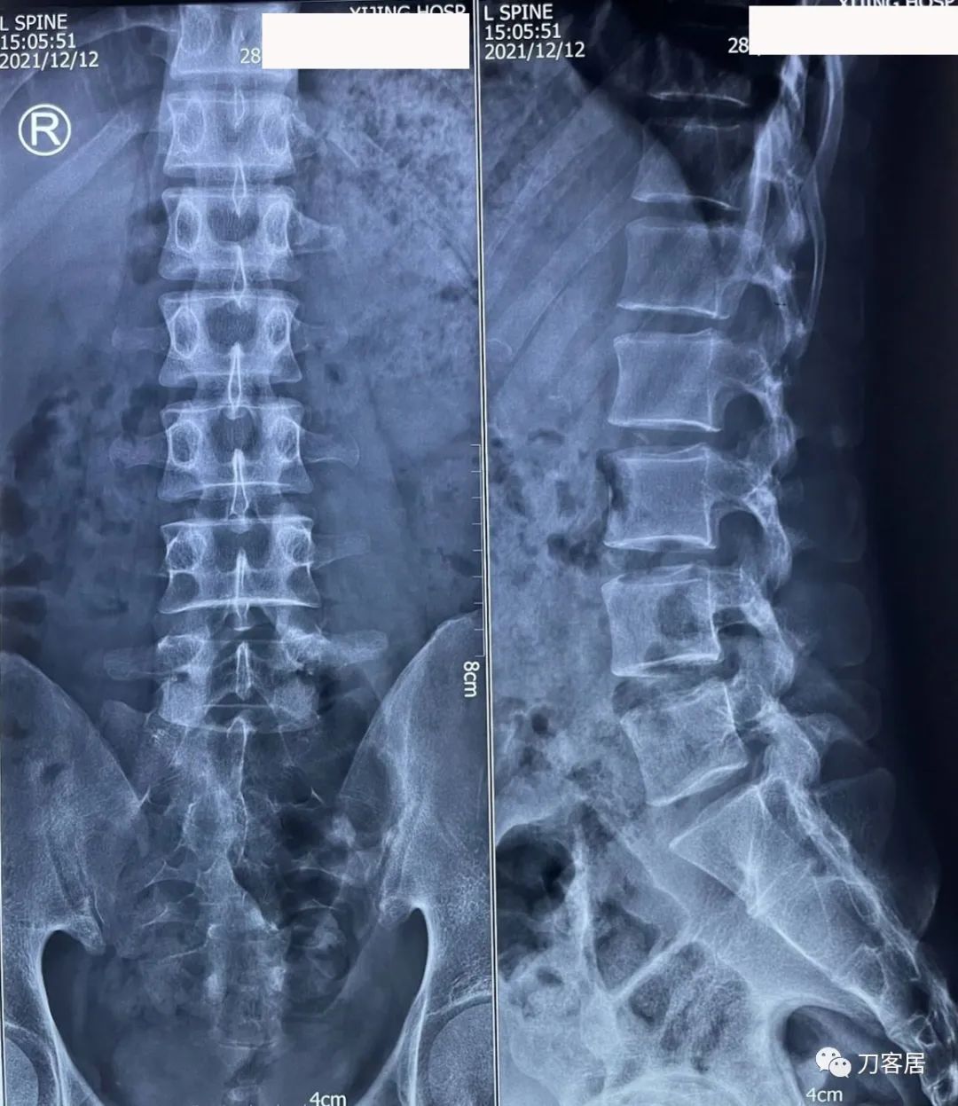 My misdiagnosis: lumbar 5 sacral 1 intervertebral disc herniation ...