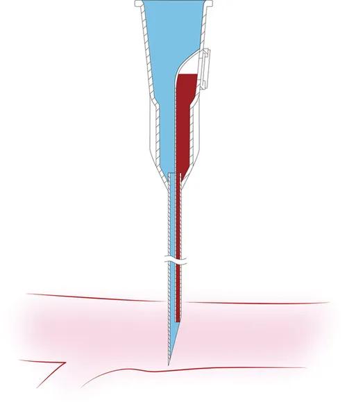 This hyaluronic acid needle actually has its own anti-embolism function ...