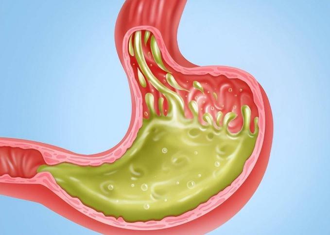 Laryngopharyngeal reflux in patients with gallbladder stones, and the ...