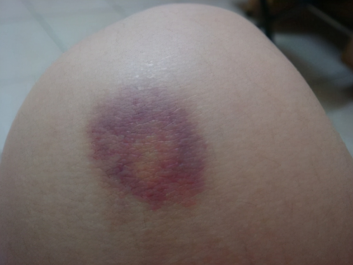 Ten women have nine blood stasis, 3 simple methods to remove blood ...