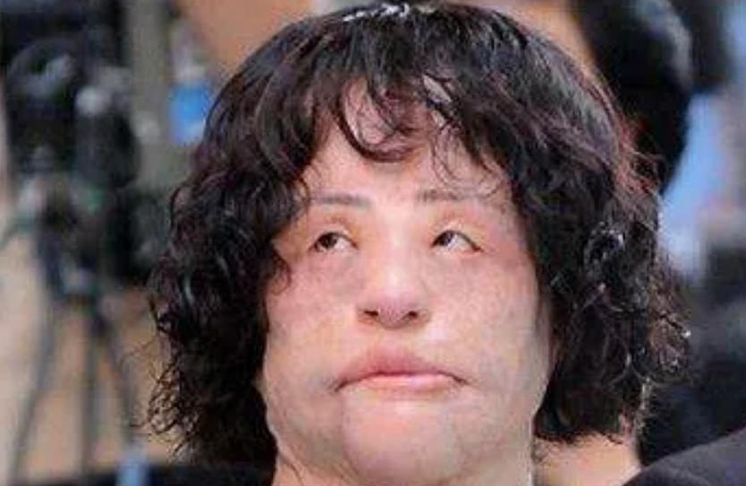 "Obsessed with plastic surgery" Han Huijing, crazily injected soybean ...