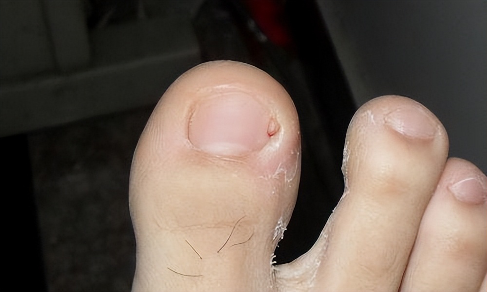 What is the origin of the person whose little toe fingernail is divided ...