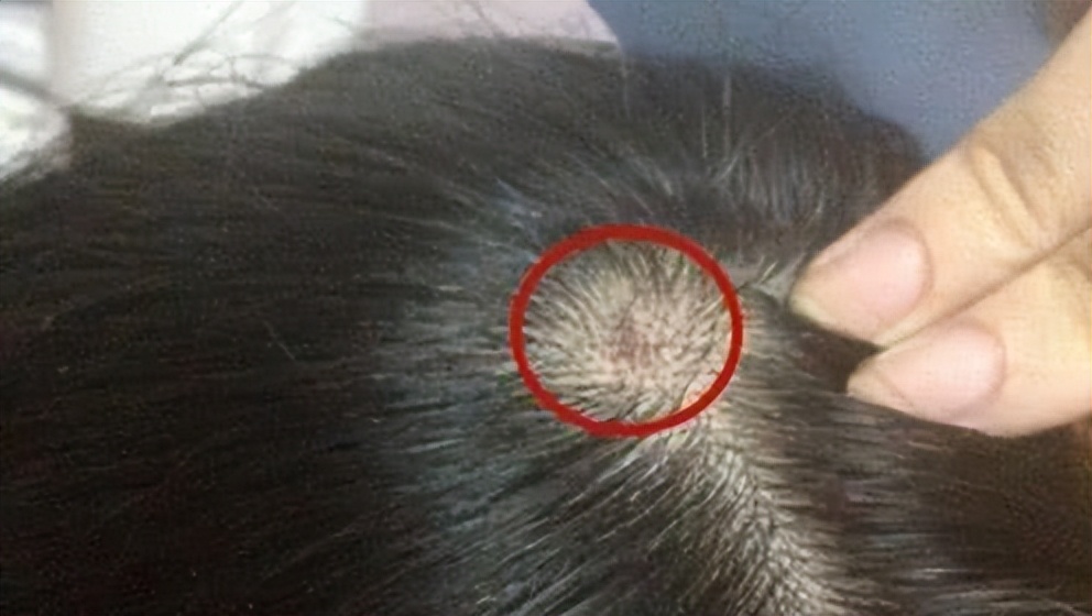 Pustules and pimples often grow on the scalp, what's the matter?Doctor ...