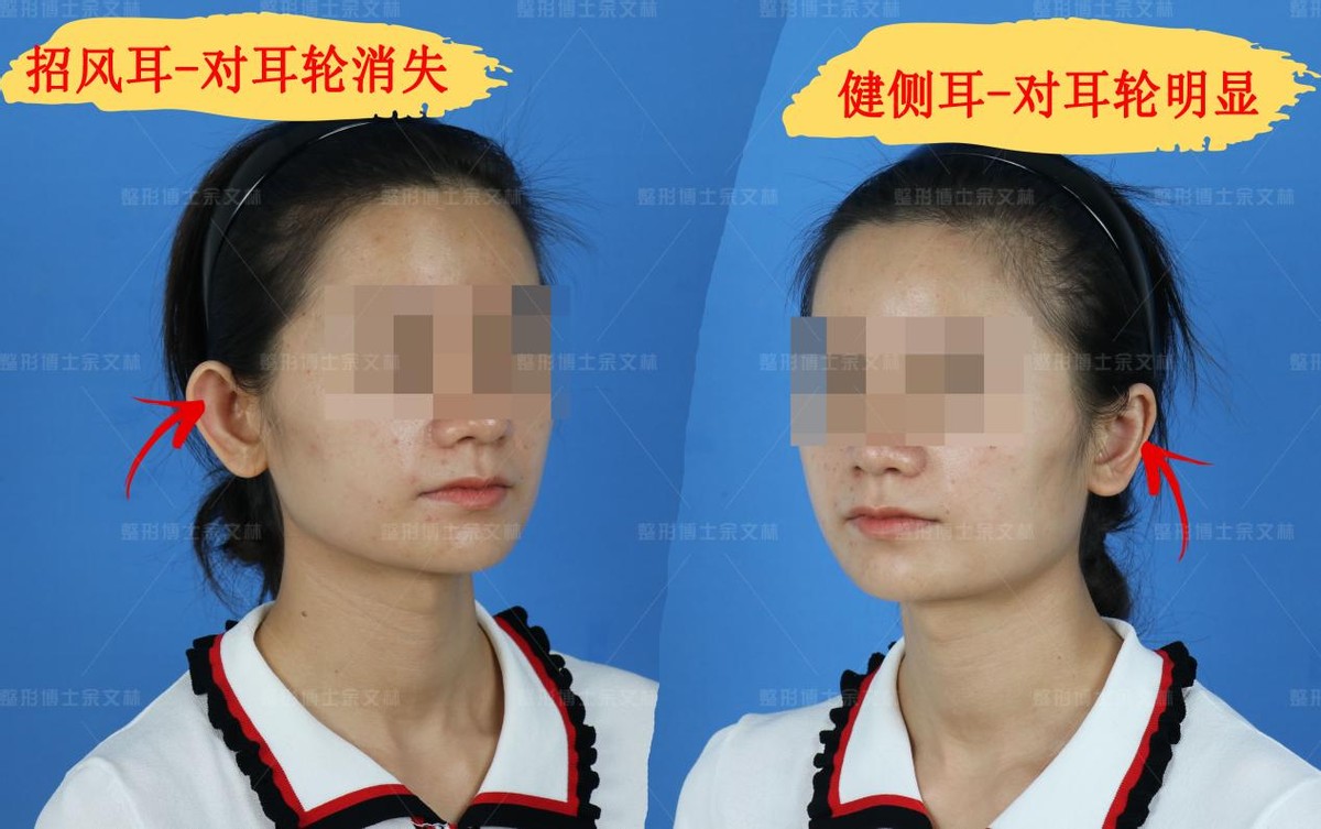 Can unilateral wind-induced ears be corrected to be the same as the ...