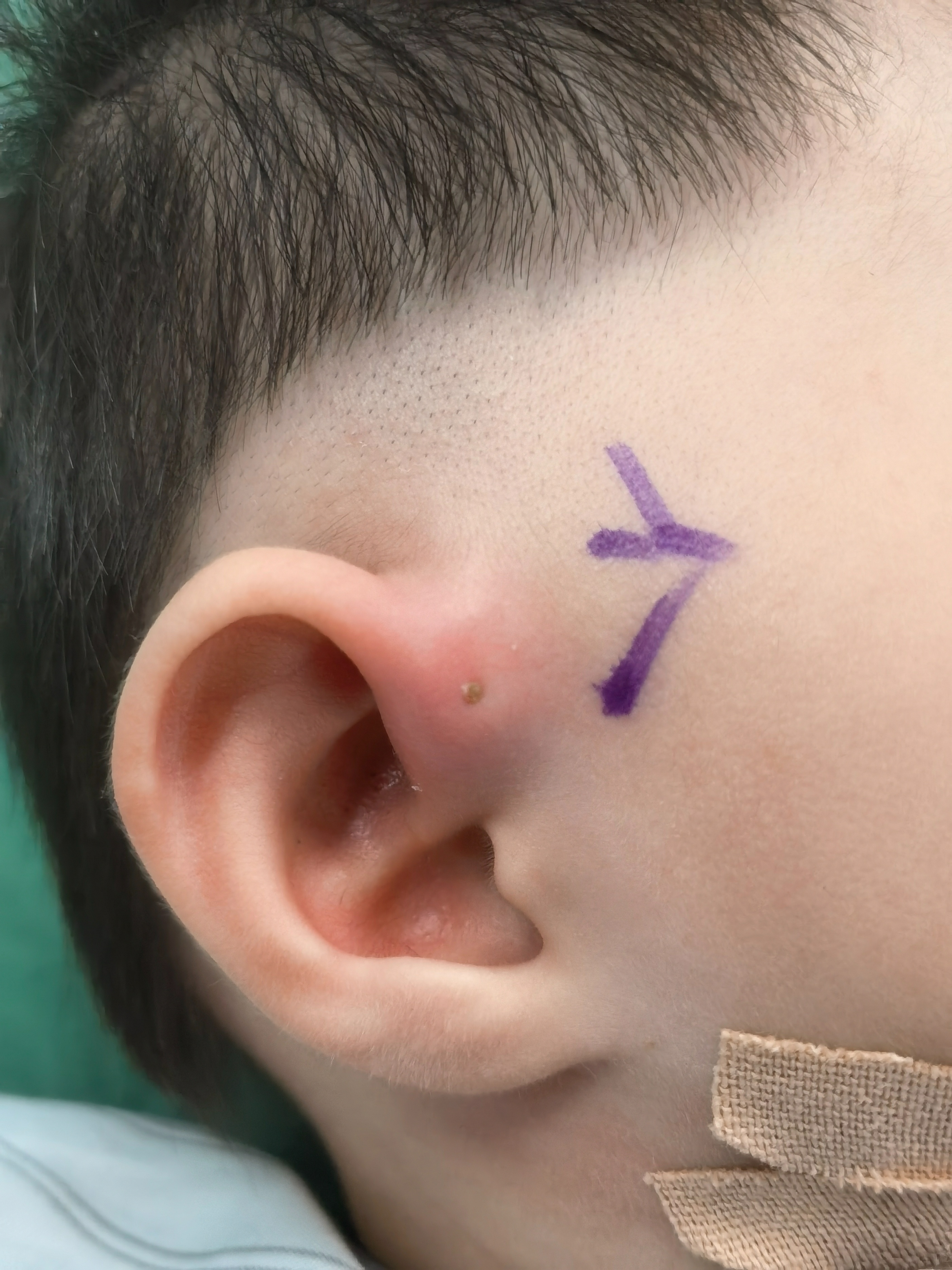 A child of several months, the preauricular fistula is inflamed, and I ...