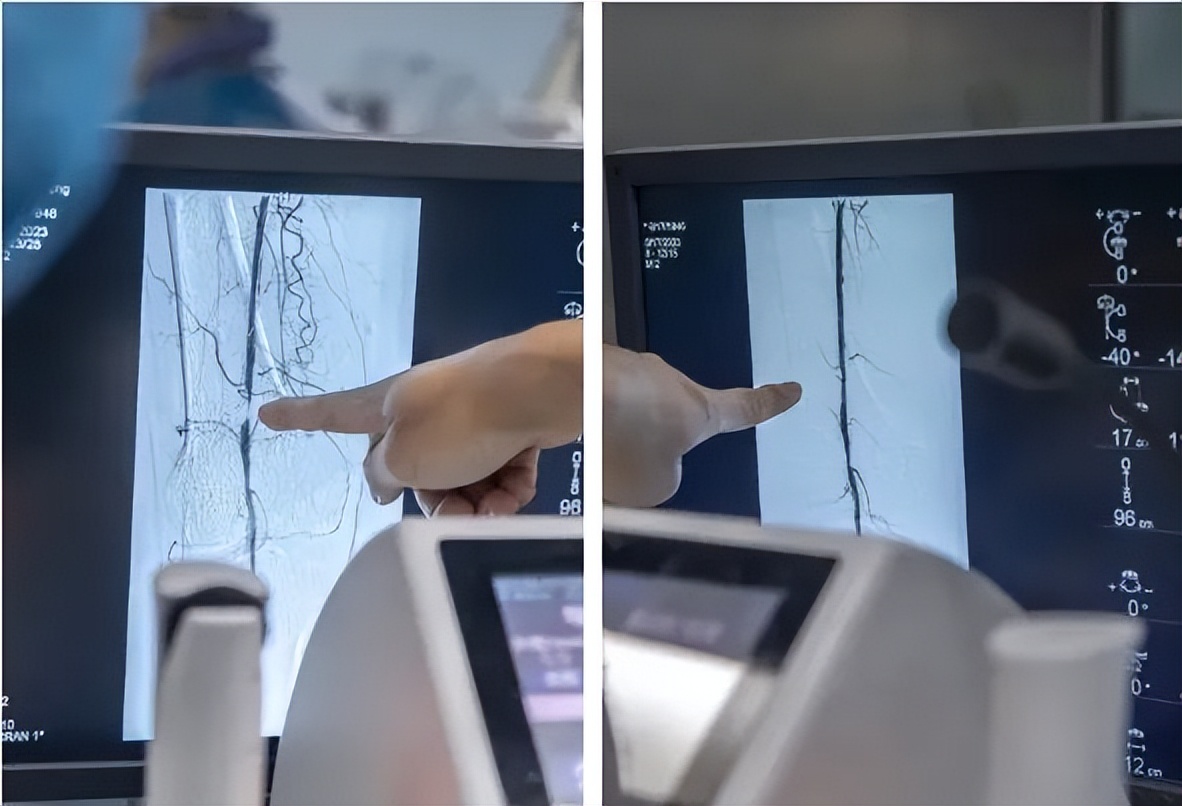 Vascular Surgery Successfully Implemented Robot-Assisted Peripheral ...