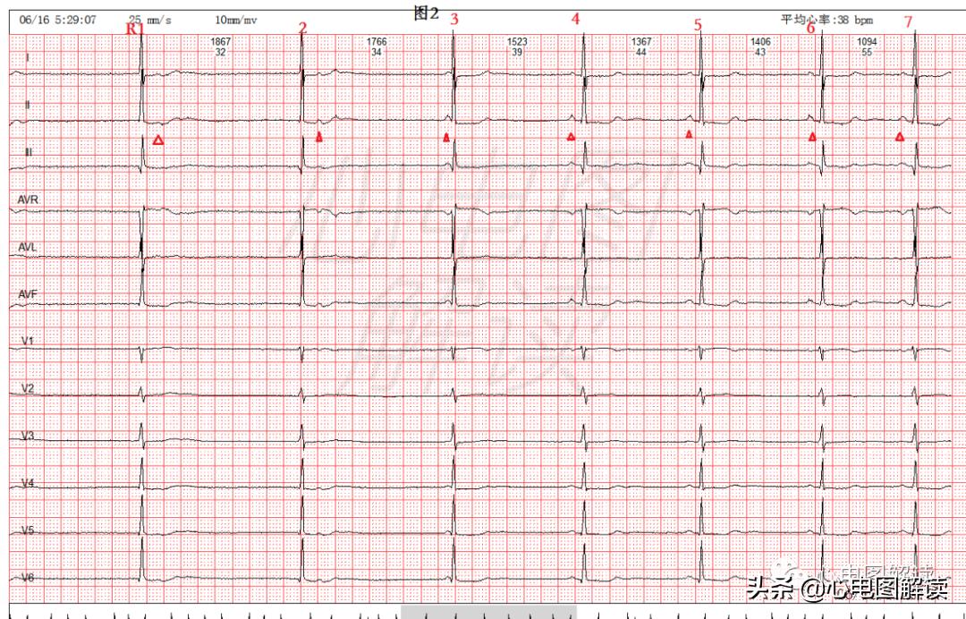 (brady) junctional escape beat (heart rhythm) and one of its causes - iNEWS