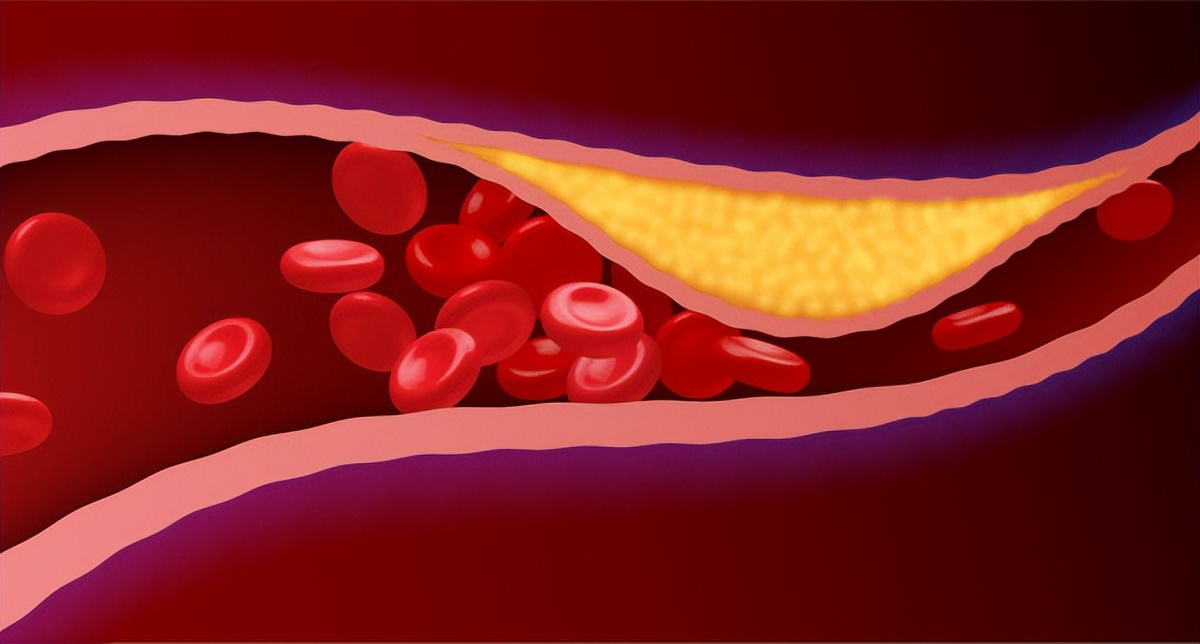 Men and women have their own accelerated periods of blood lipid growth ...