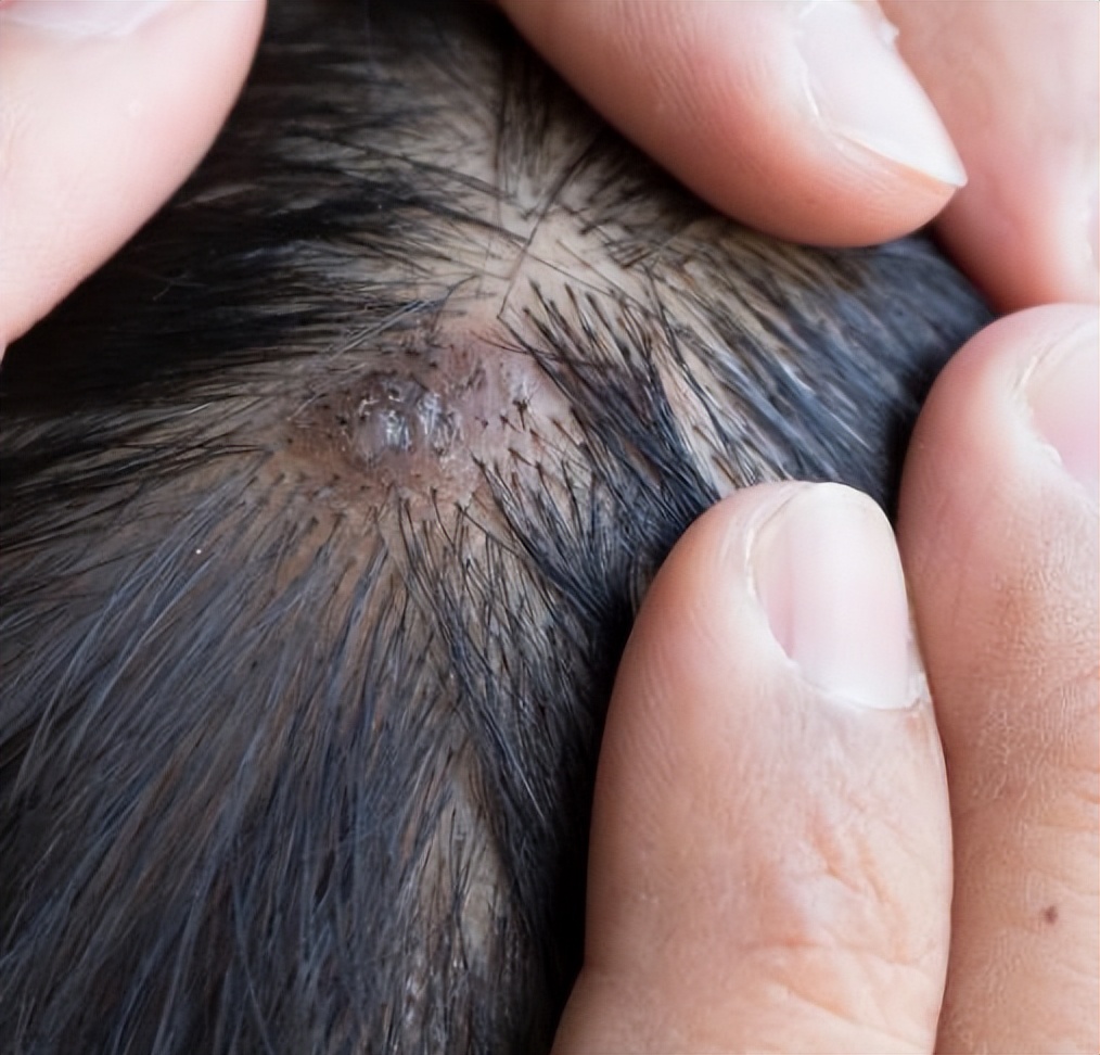 Pustules and pimples often grow on the scalp, what's the matter?Doctor ...