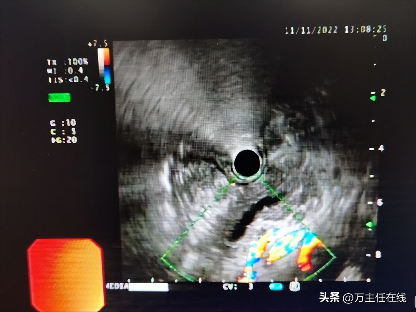 Professor Yi Wanrong from Shanghai successfully relieved a patient with ...