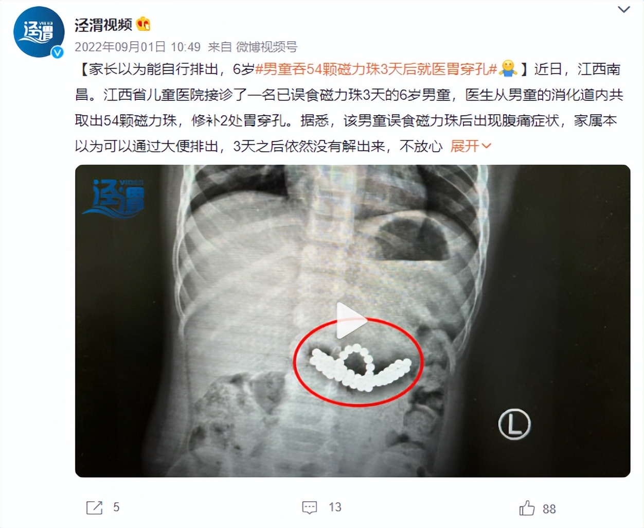 From abdominal pain and bloating to shock, this eating illness can be ...