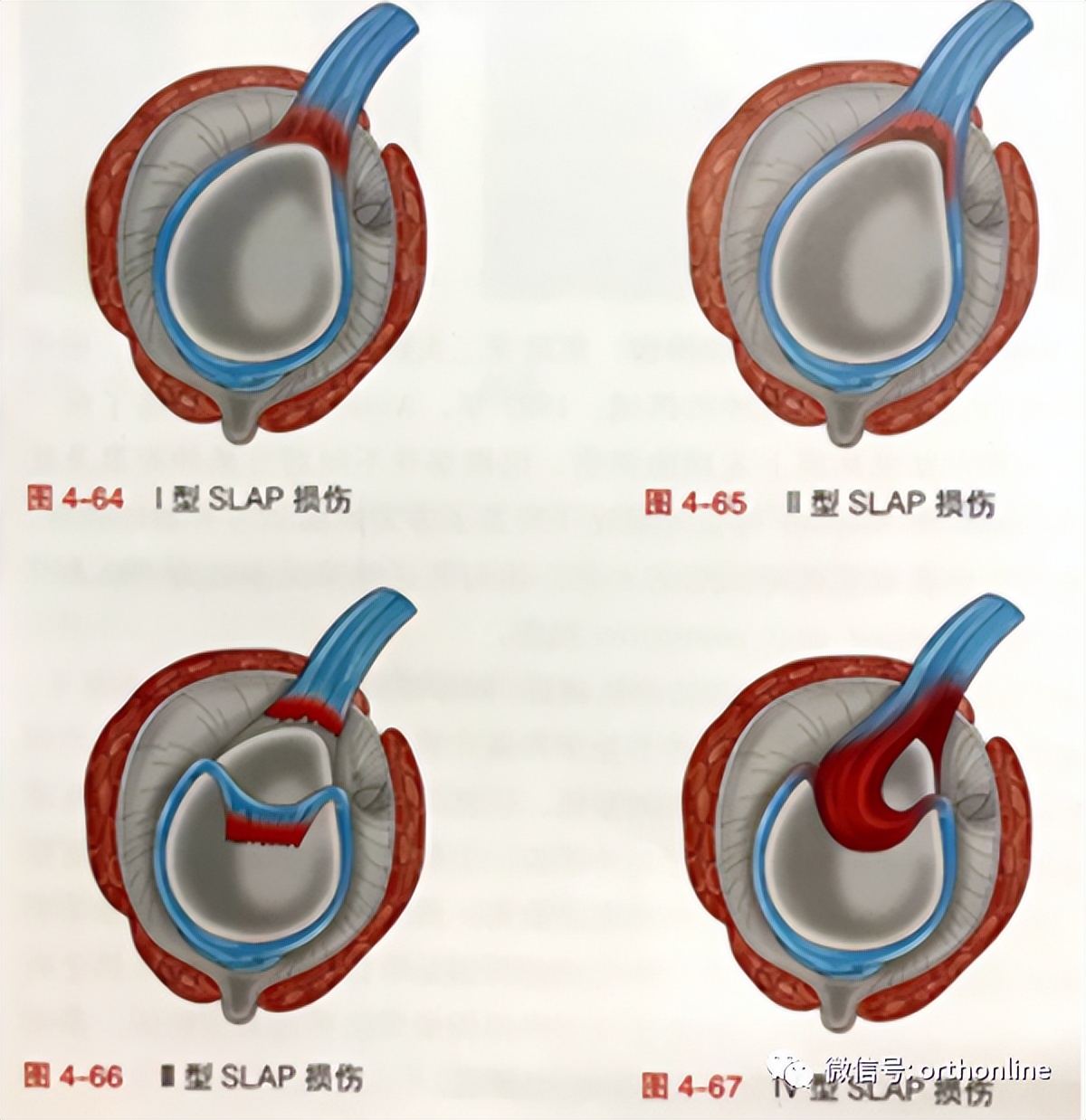 Diagnosis and treatment of a common shoulder injury——SLAP injury - iNEWS