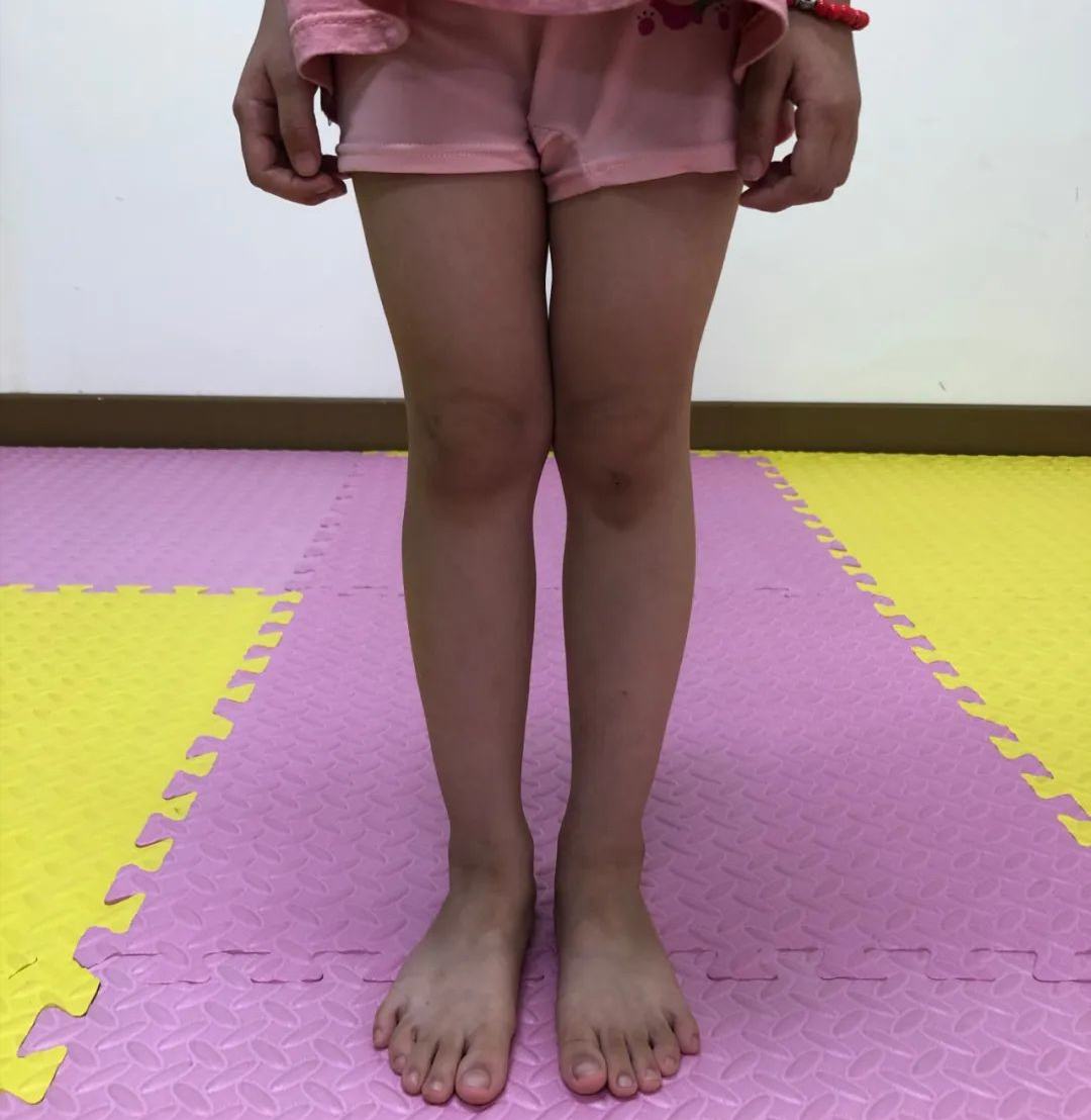 To judge whether the child's leg shape is normal, pay attention to two ...