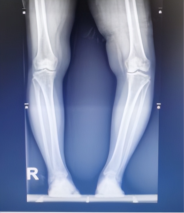 "After osteotomy and knee protection, my hooped legs have straightened ...
