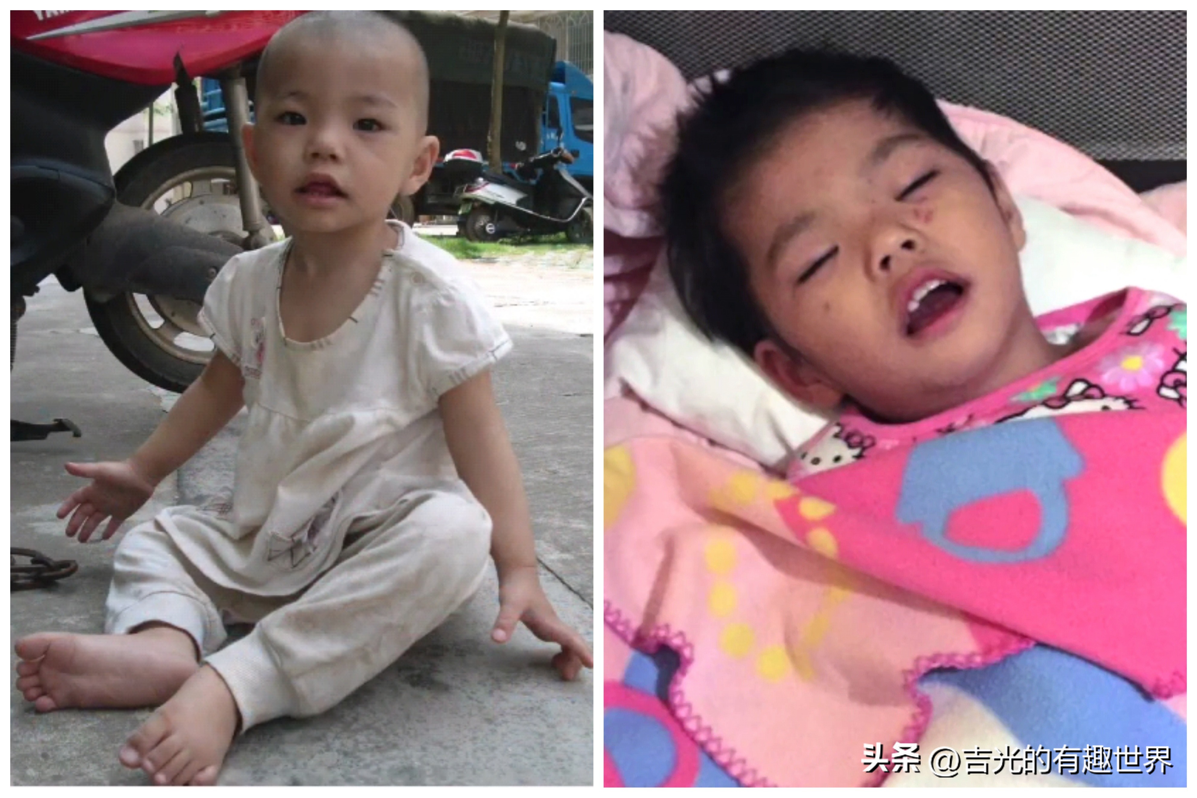 A Chinese orphan suffering from a rare disease has changed surprisingly ...