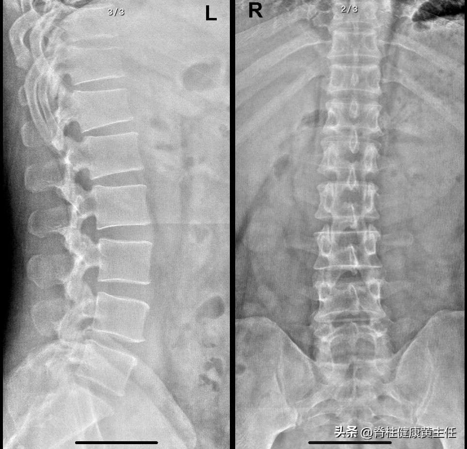 Lumbar pain and limited bending movement, how to treat? Please read ...