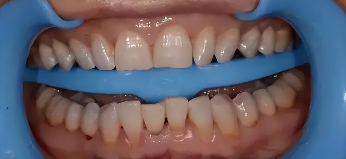 What is a dead pulp tooth?People with dead pulp teeth are more prone to ...