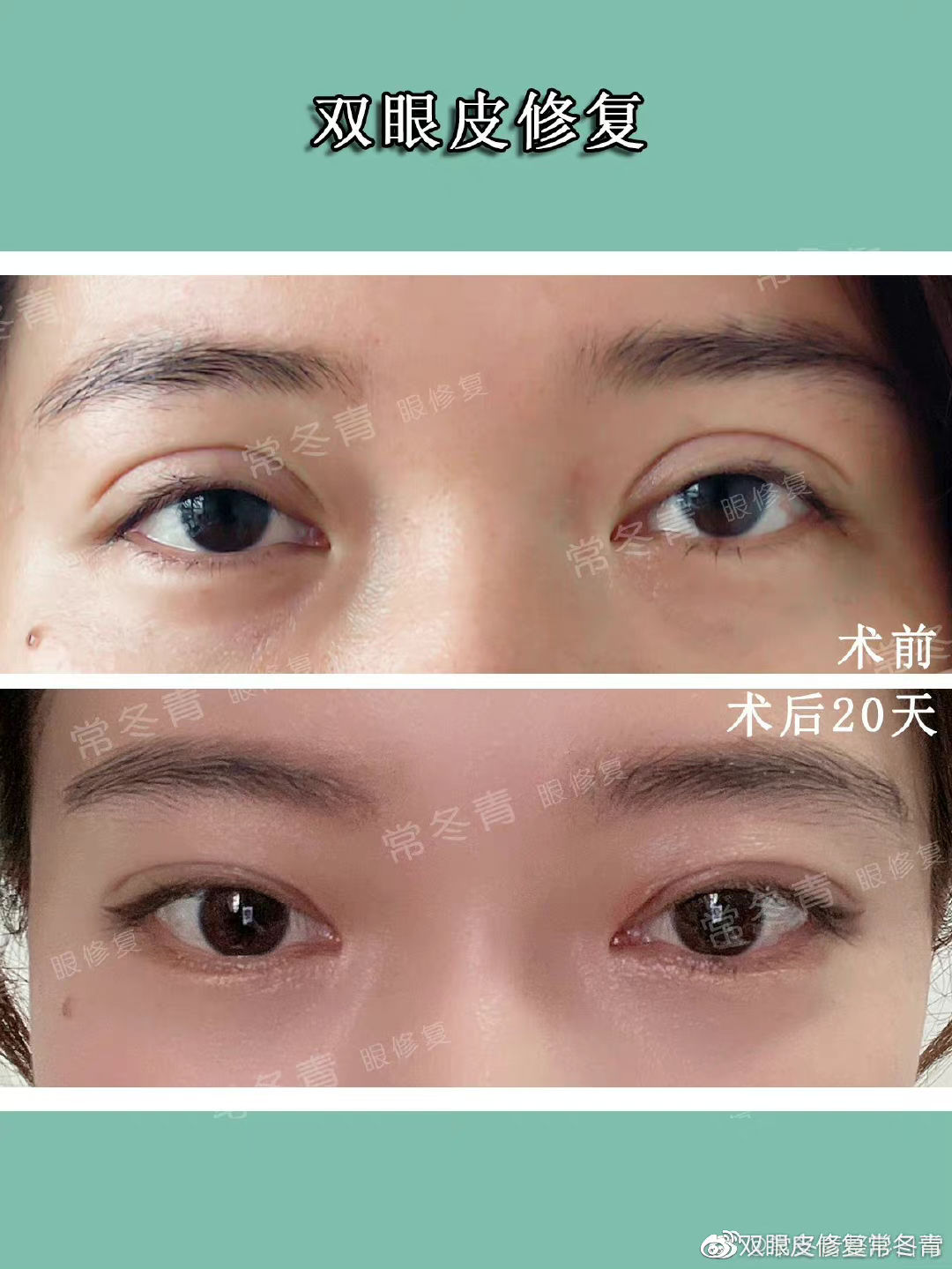 6-month photo feedback of double eyelid repair - double eyelid width ...