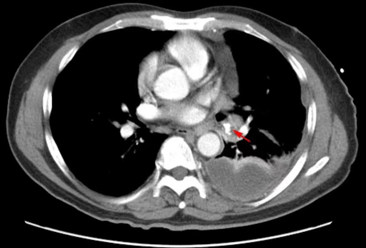 The man coughed and coughed up phlegm repeatedly for 20 years, but the ...