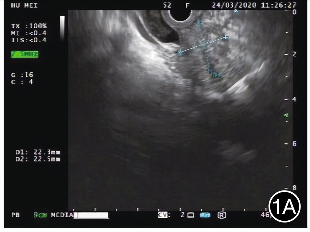 Diagnostic value of endoscopic ultrasound-guided fine needle aspiration for pancreas combined ...