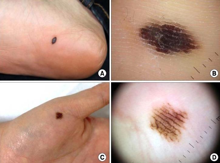 How likely is a mole on your body to become cancerous? - iNEWS