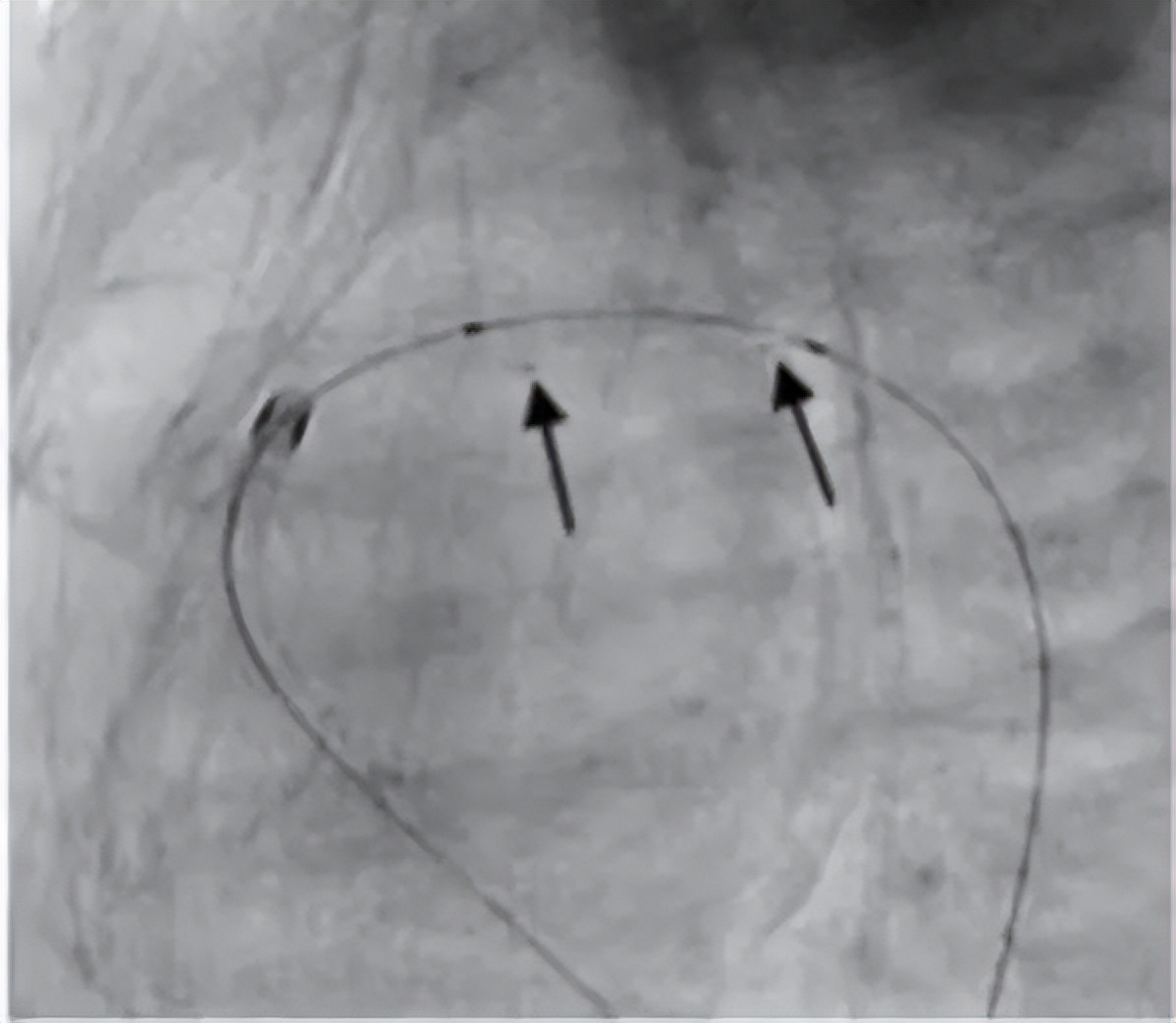 The world's first iron-based absorbable stent approved - iMedia