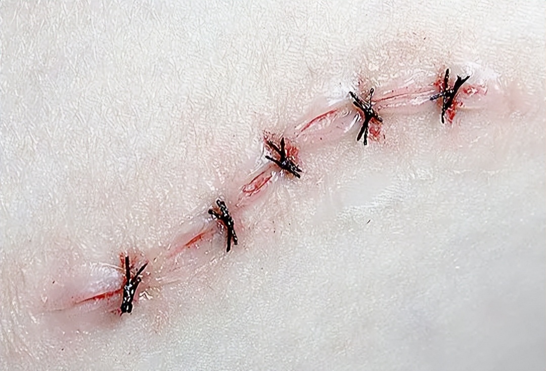 What should I do if the scar is still itchy after a year of surgery?How ...